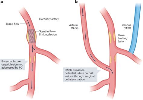 Coronary Artery Stent
