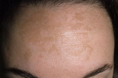 თუთიის მალამო იაფი და ეფექტური ხელმისაწვდომი პრეპარატი