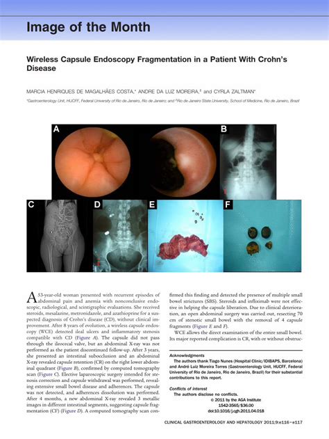 pdf wireless capsule endoscopy fragmentation in a patient with crohn