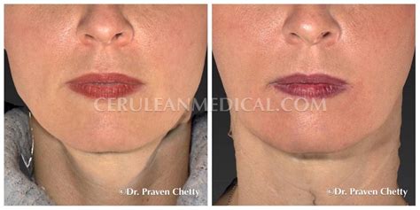 Botox Kelowna Before And After Photos