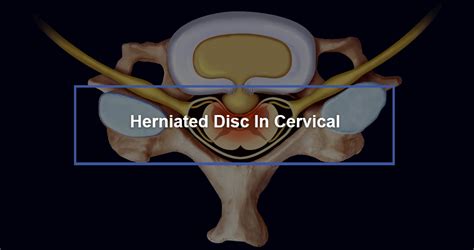 Herniated Disc In Cervical Dr Kevin Pauza The Discseel® Procedure