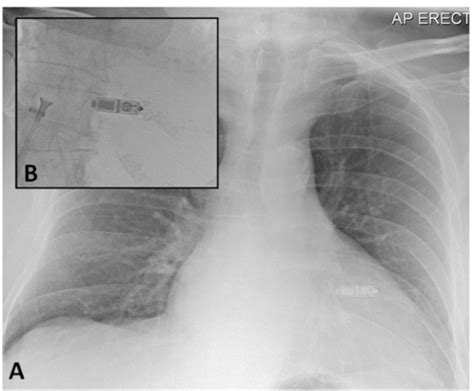 Cardiac Anesthesia Pv Loop Images Flashcards Quizlet