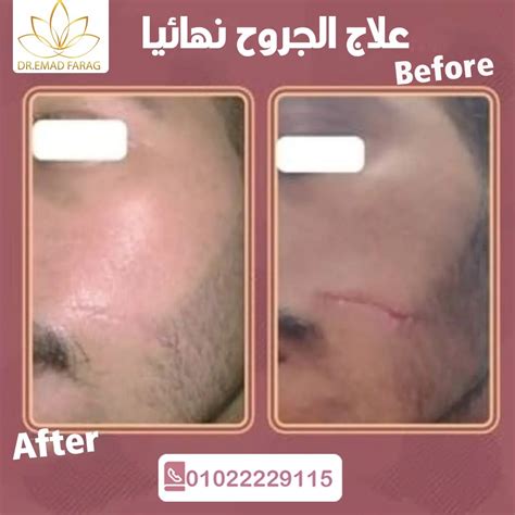 علاج الجروح نهائيا دكتور تجميل دكتور عماد فرج