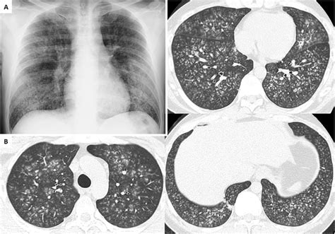 Chest Radiography On Admission Showing Diffuse Reticulonodular Download Scientific Diagram