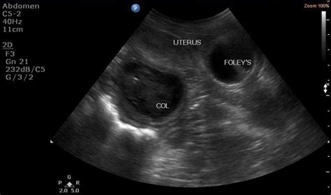 Trans Rectal Sonographic Guided Catheter Drainage Of Pelvic Collection