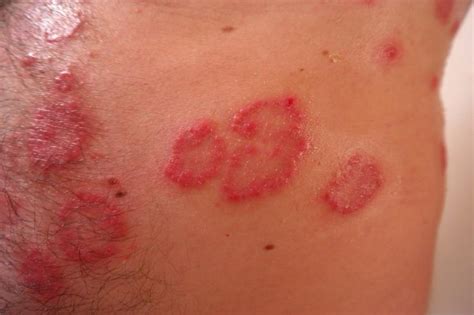 Gejala Dan Penyebab Psoriasis Penyakit Yang Harus Diwaspadai Majalah