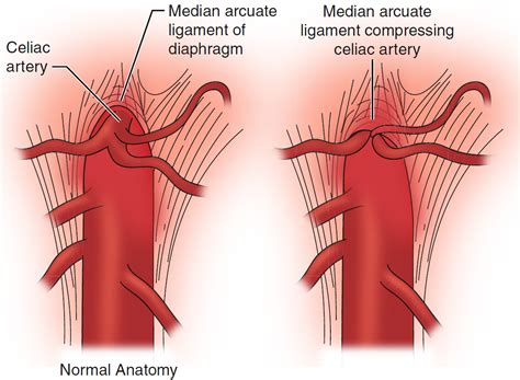 Arcuate Ligament