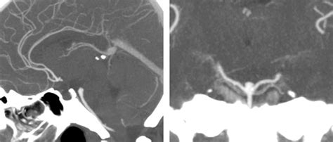 Basilar Aneurysm Subtemporal Approach The Neurosurgical Atlas