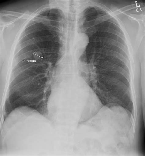 Cxr Demonstrating Increased Rul Nodule Size To 2 2 Cm Download