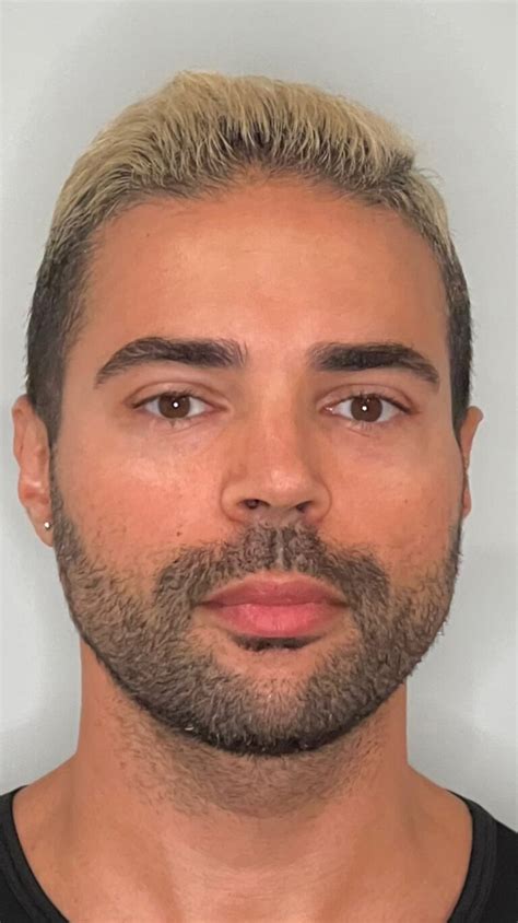 Chin And Cheek Filler Element Medical Aesthetics