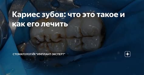 Кариес зубов что это такое и как его лечить Стоматология Имплант Эксперт Дзен