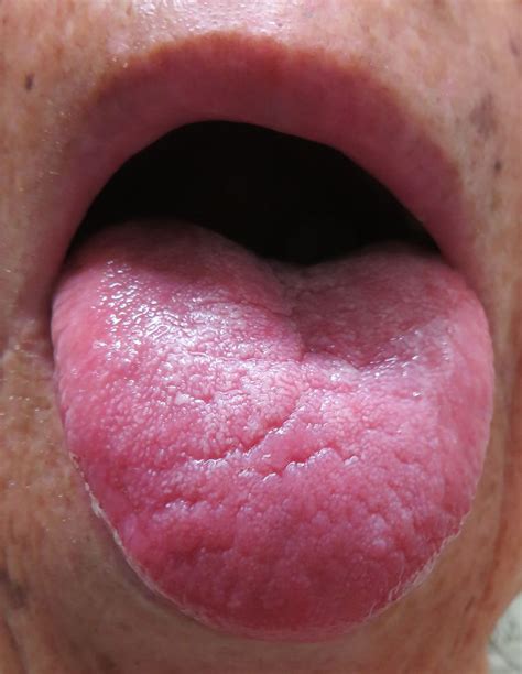 Moeller Hunter Glossitis Bmj Case Reports