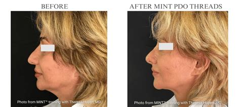 Mint Pdo Threads Non Surgical Facelift In Nj