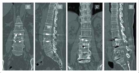 Thin Slice Postoperative Computed Tomography Ct Scan Showing The