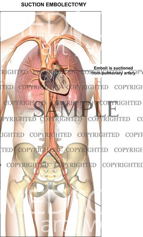 Suction Embolectomy Medical Art Works