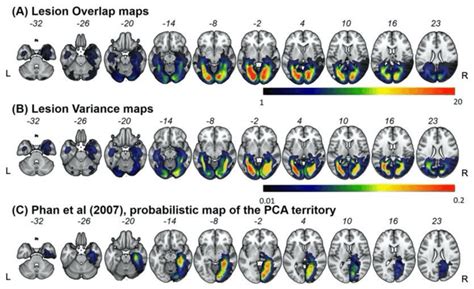 Lesion Overlap And Variance Maps For The 64 Pca Stroke Cases L Left Download Scientific