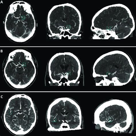 Algorithm Output Of Three Patients Showing Maximum Intensity Projection Download Scientific