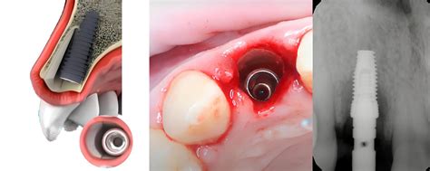 Immediate Implant Prosthetics Risk Matrix And Workflow Tips