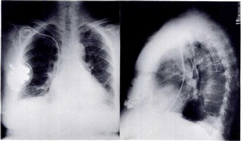Diaphragmatic Origin Of The Pacemaker Sound Chest