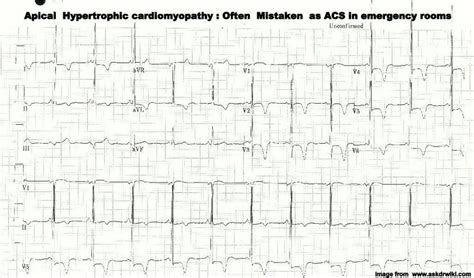 Apical Hypertrophy Drsvenkatesan Md