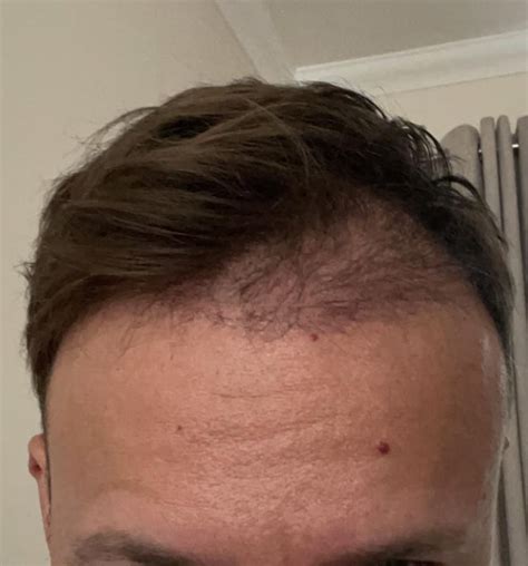 25 Month Update Before And After Hlc Ankara Turkey 3500 Grafts In Frontal Third R