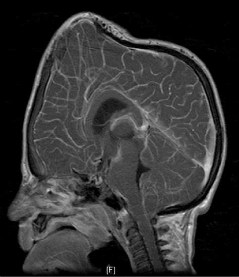 Mri Ti Sagittal With Contrast Showing Chiari Type 1 Malformation
