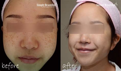 Laser Melasma And Pigmentation Removal Dr Peter Kim Cosmetic And Laser Clinic