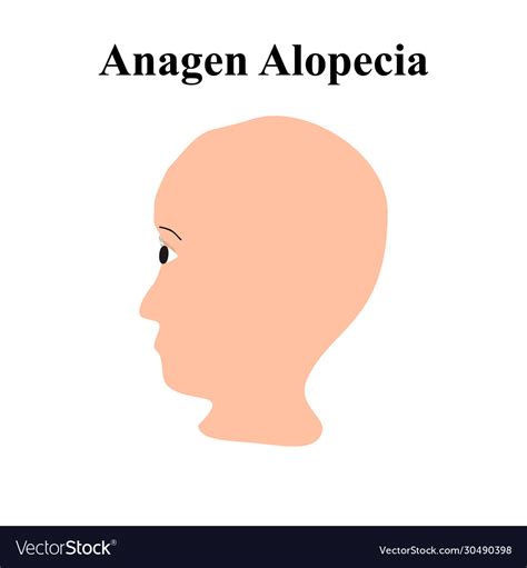 Alopecia Hair Baldness On Head Royalty Free Vector Image