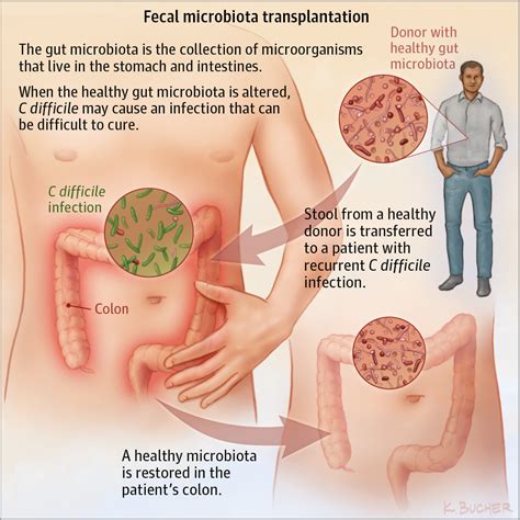 Fecal Microbiota Transplantation Gastroenterology Jama Jama Network