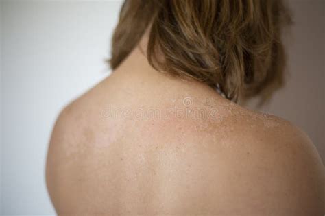 Severe Skin Damage From Sun Rays The Skin Peels Off The Body After A