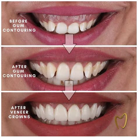 Gum Contouring Dubai Alma Polyclinic