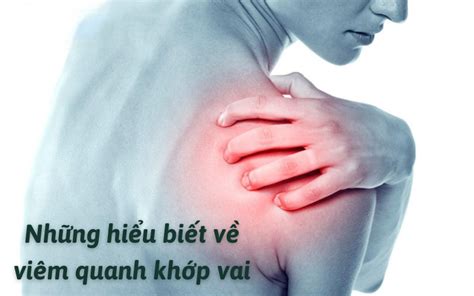 Viêm quanh khớp vai Nguyên nhân triệu chứng cách phục hồi