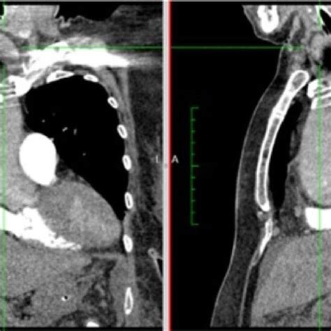 Ctpa Showing Innominate Artery At Level Of C7 Download Scientific Diagram