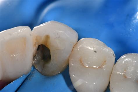 Amalgam Incompatibility With Tooth Structure