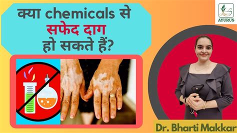 What Is Contact Leucoderma Chemical Leucoderma Hair Dye Watch Straps Rubber Footwear Bindi