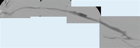 Superb Tricks For Cpt Code For Tunneled Central Venous Version