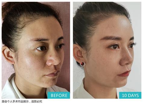 35岁李女士，做完膨体泪沟填充手术10天了，坦白几点感受（过来人的忠告一定要听） 知乎