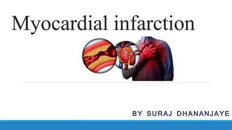 Myocardial Infarction Pptx