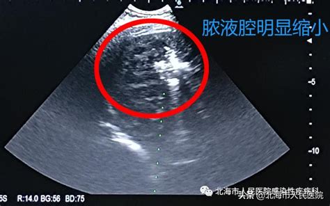 市人民醫院感染性疾病科又完成一例超聲引導下肝膿腫穿刺抽膿術 每日頭條