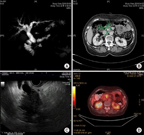 Preoperative Imaging A Magnetic Resonance Cholangiopancreatoscopy