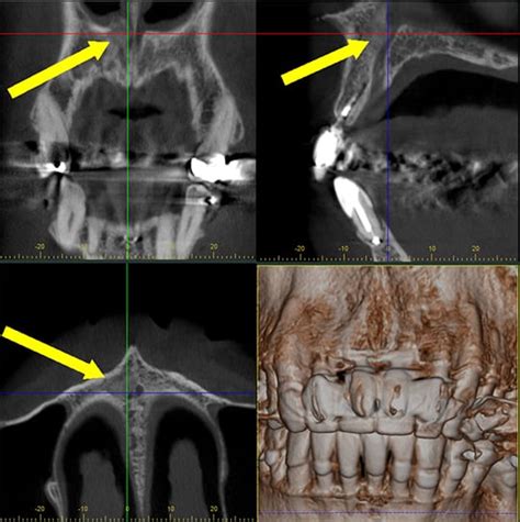 Cone Beam Ct Interpretation American Association Of Endodontists