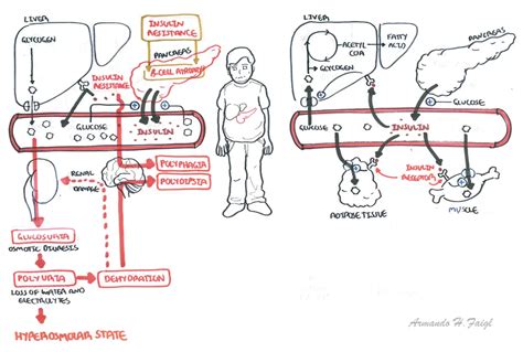 Type 2 Diabetes Pathophysiology Diagram