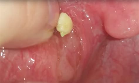 No Tonsils And Still Have Tonsil Stones