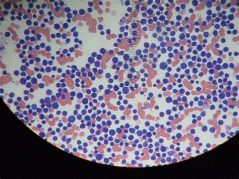 Estados Unidos Autoriza La Primera Terapia Genética Contra El Cáncer