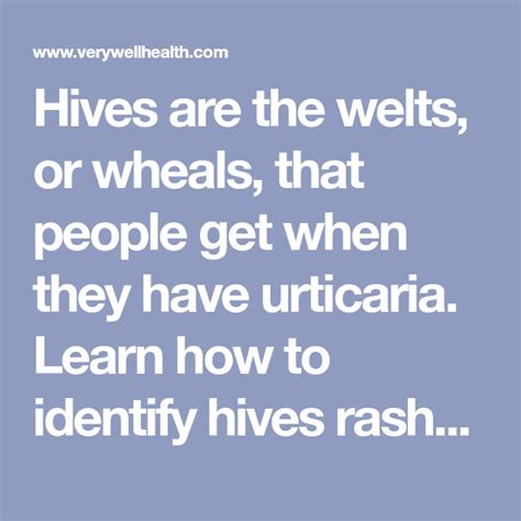 Hives Are The Welts Or Wheals That People Get When They Have