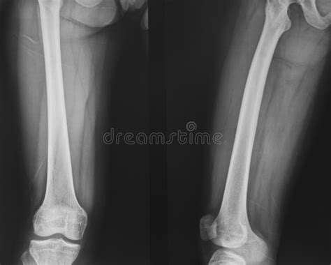 Rodilla Normal De La Radiografía Imagen De Archivo Imagen De Roentgen