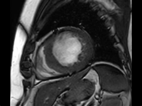 Myocardial Infarction With T1t2 Mapping Philips Mr Body Map