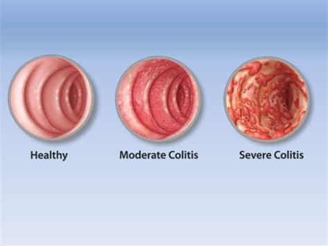 Endoscopy Role In Inflammatory Bowel Disease Endoscopy Hisory
