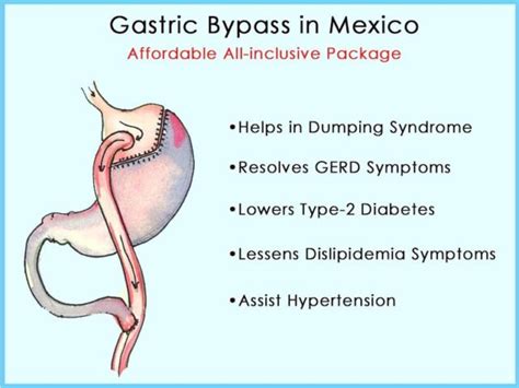Gastric Bypass In Mexico Low Cost And Safe All Inclusive ‎ 5199