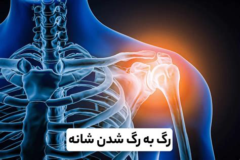 درمان رگ به رگ شدن شانه دکتر ابراهیم زاده